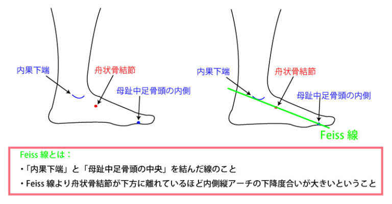 フェイス線（Feiss線）とは？ ｜ 足のアーチを確認しよう（偏平足）